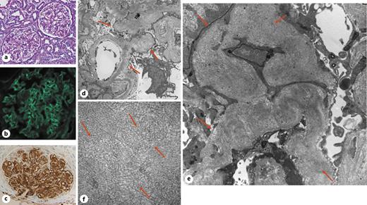 Recurrent Glomerular Diseases in Renal Transplantation with Focus on ...