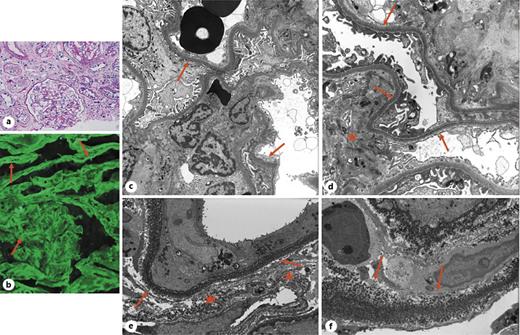 Recurrent Glomerular Diseases in Renal Transplantation with Focus on ...