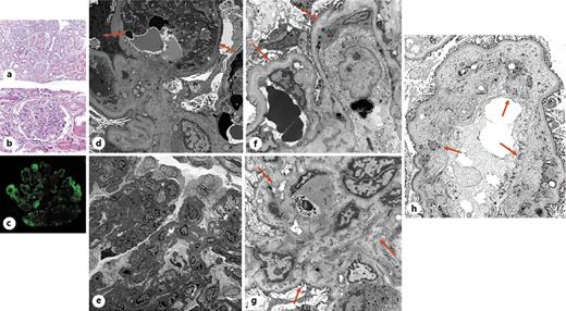 Recurrent Glomerular Diseases in Renal Transplantation with Focus on ...