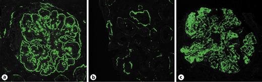 C3 Glomerulopathy: A Review with Emphasis on Ultrastructural Features ...