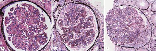 C3 Glomerulopathy: A Review with Emphasis on Ultrastructural Features ...