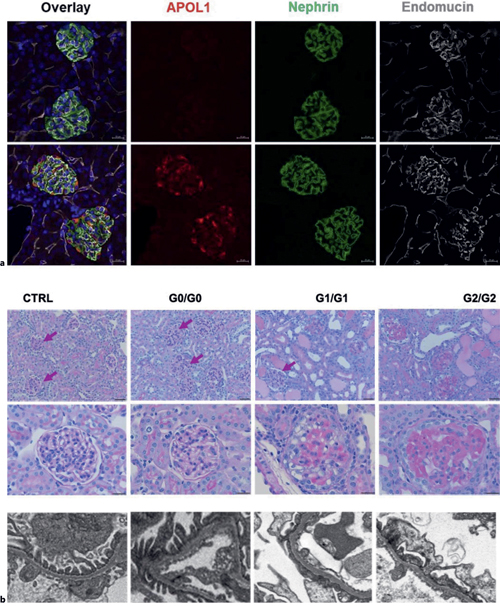 APOL1 and APOL1-Associated Kidney Disease: A Common Disease, an Unusual ...