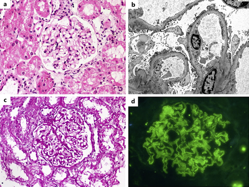 Patterns of Renal Dysfunction and Profile of Kidney Biopsies in ...