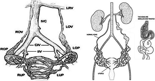 Diagnosis and Management of Pelvic Congestion Syndrome: Comprehensive ...