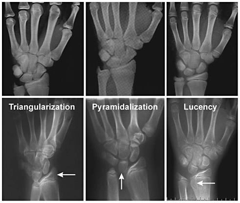 Short Stature due to SHOX Deficiency: Genotype, Phenotype, and Therapy ...