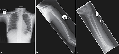 Two Siblings with a Mutation in CCDC8 Presenting with Mild Short ...