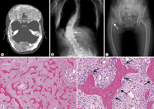 The Clinical Spectrum of McCune-Albright Syndrome and Its Management ...