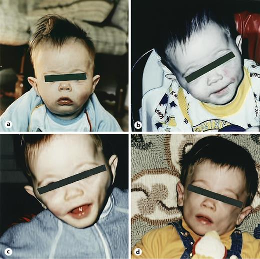 Lipodystrophies in Children | Hormone Research in Paediatrics | Karger ...