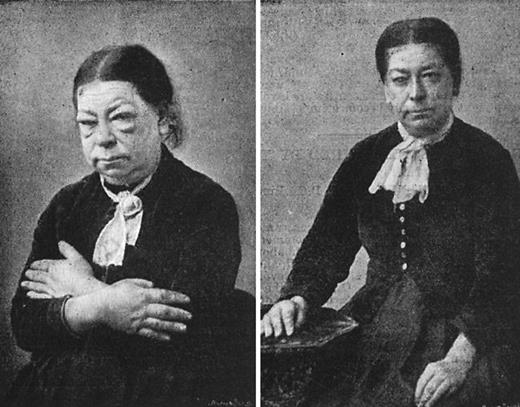 History of the Thyroid | Hormone Research in Paediatrics | Karger ...