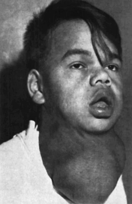 History of the Thyroid | Hormone Research in Paediatrics | Karger ...