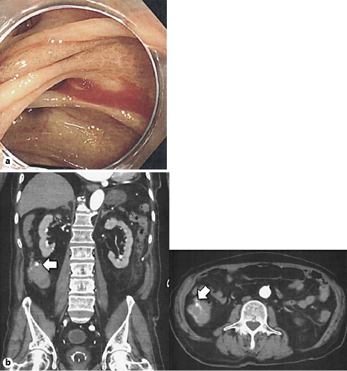 Management of Diverticular Hemorrhage: Catching That Culprit ...