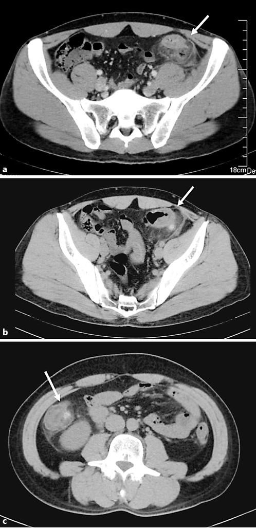 The Burden of Diverticular Disease and Its Complications: West versus ...