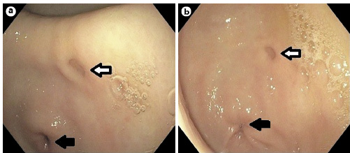 Gastric Diverticulum: A Comprehensive Review | Inflammatory Intestinal ...