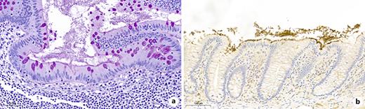 Spirochetosis Mimicking Acute Appendicitis: Clinical Report and Review ...