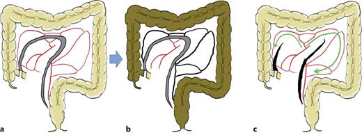 Laparoscopy-Assisted Restorative Proctocolectomy with Ileal Pouch-Anal ...