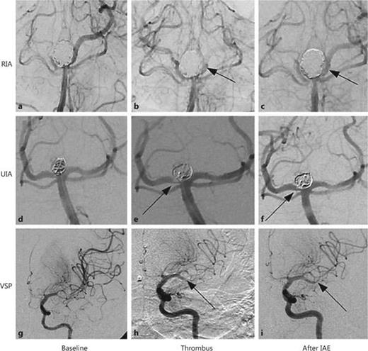Intra-Arterial Eptifibatide in the Management of Thromboembolism during ...