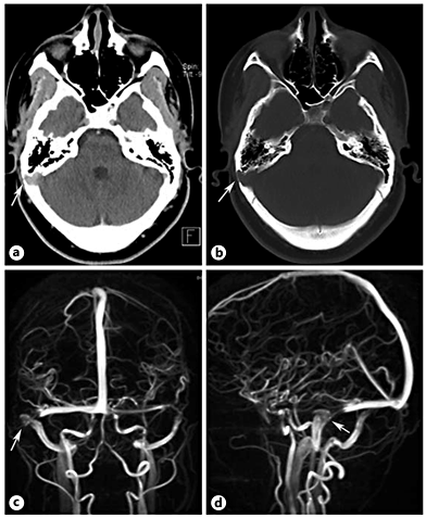 Endovascular Management of Sigmoid Sinus Diverticulum | Interventional Neurology | Karger Publishers