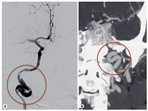 Internal Carotid Artery S-Shaped Curve as a Marker of Fibromuscular ...