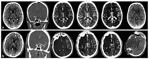 Improving the Evaluation of Collateral Circulation by Multiphase ...