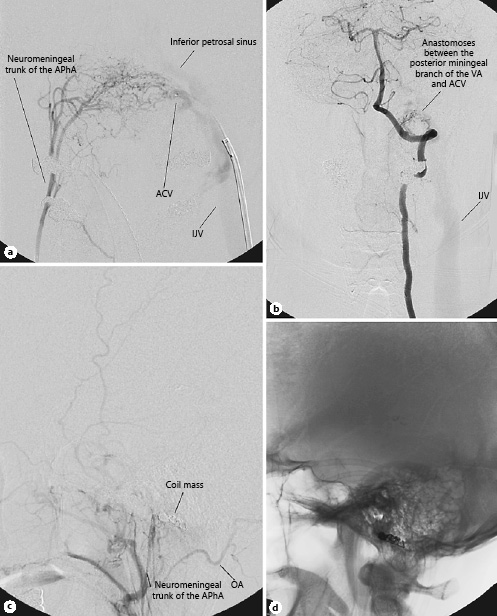 Transvenous Embolization of Dural Arteriovenous Fistulas of the ...