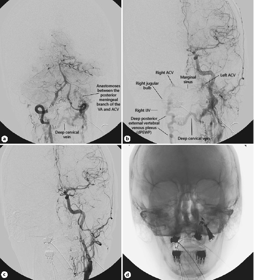 Transvenous Embolization of Dural Arteriovenous Fistulas of the ...