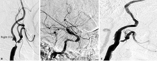 Carotid Revascularization with and without the Use of an Embolic ...