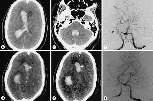 Isolated Intraventricular Hemorrhage Associated with Cerebral Vasospasm and Delayed Cerebral ...