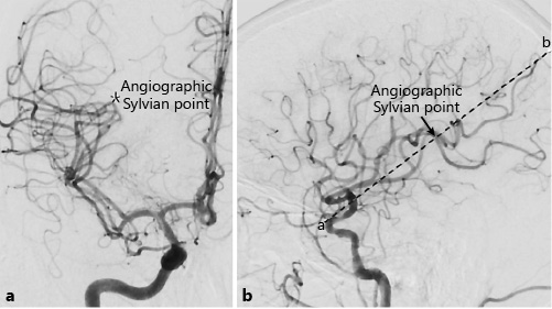 The Angiographic Anatomy of the Sphenoidal Segment of the Middle Cerebral Artery and Its ...