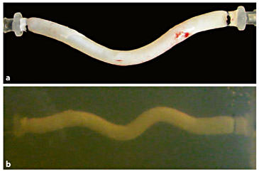 Twisted Blood Vessels: Symptoms, Etiology and Biomechanical Mechanisms ...