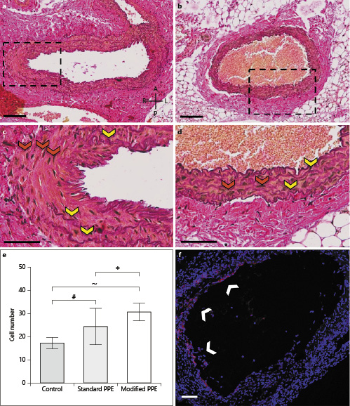 Effects of Iliac Stenosis on Abdominal Aortic Aneurysm Formation in ...
