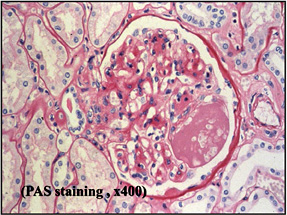 Pathogenesis and Treatment of Chronic Kidney Disease: A Review of Our ...