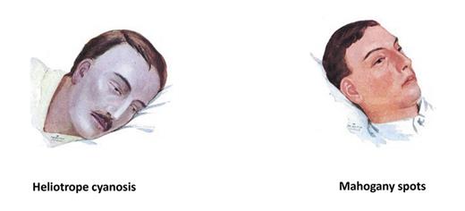 The 1918 Influenza Pandemic: Back to the Future? | Kidney and Blood ...