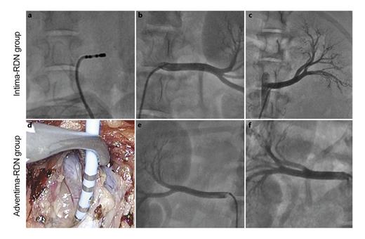 Renal Interstitial Fibrosis Is Reduced in High-Fat Diet-Induced Obese ...