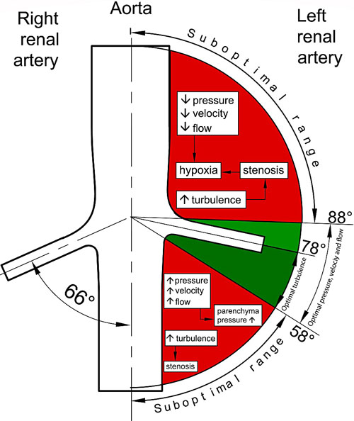 Optimal Renal Artery-Aorta Angulation Revealed by Flow Simulation ...