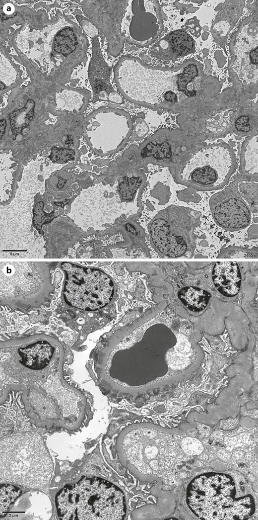 Segmental Membranous Glomerulopathy in Adults | Kidney Diseases ...