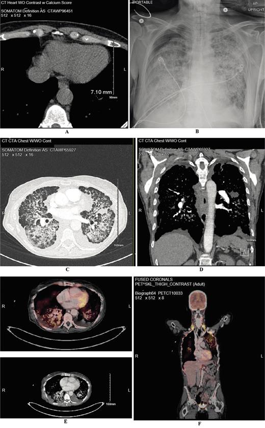 Ungewöhnliche Präsentation eines lepidischen Adenokarzinoms bei einer gesunden Frau | Kompass ...