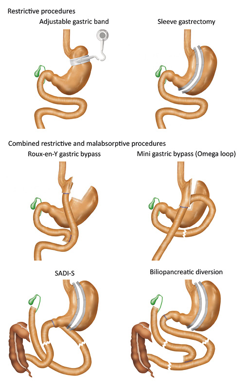 Bariatric Surgery as the Culprit of Malnutrition | Kompass Nutrition ...