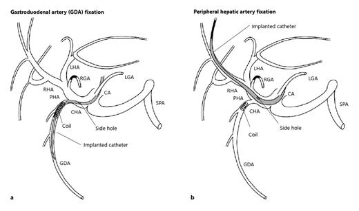 Clinical Practice Guidelines for Hepatic Arterial Infusion Chemotherapy ...