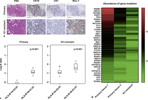 Genomic and Immune Features in an Intrahepatic Cholangiocarcinoma Patient with Microsatellite ...
