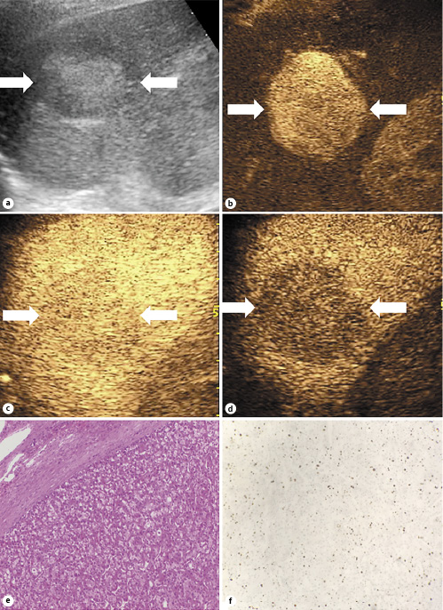 Contrast-Enhanced Ultrasound Liver Imaging Reporting and Data System in ...