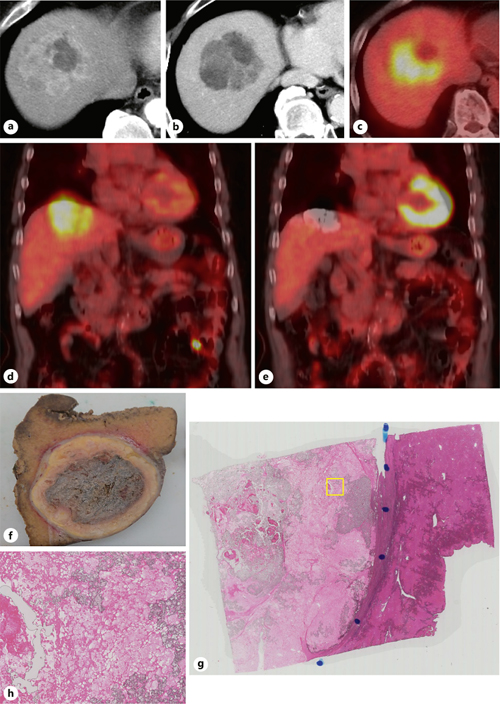Achievement of Complete Response and Drug-Free Status by Atezolizumab ...