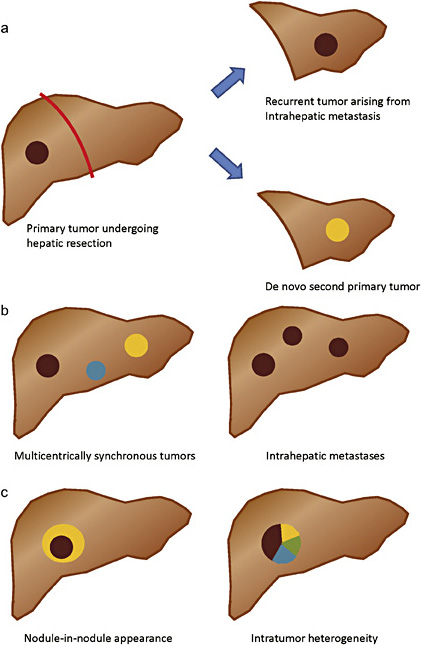 Tumor Heterogeneity in Hepatocellular Carcinoma: Facing the Challenges ...