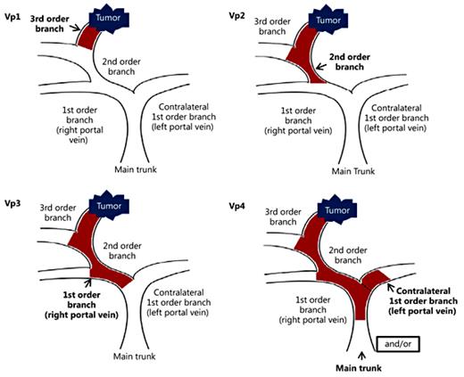 Hepatocellular Carcinoma with Macrovascular Invasion: Defining the ...