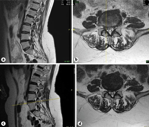 Clinical and Radiological Follow-Up Results of Patients with ...