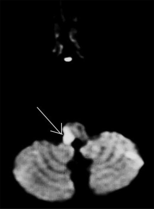 Antithrombotic Management in Ischemic Stroke with Essential ...