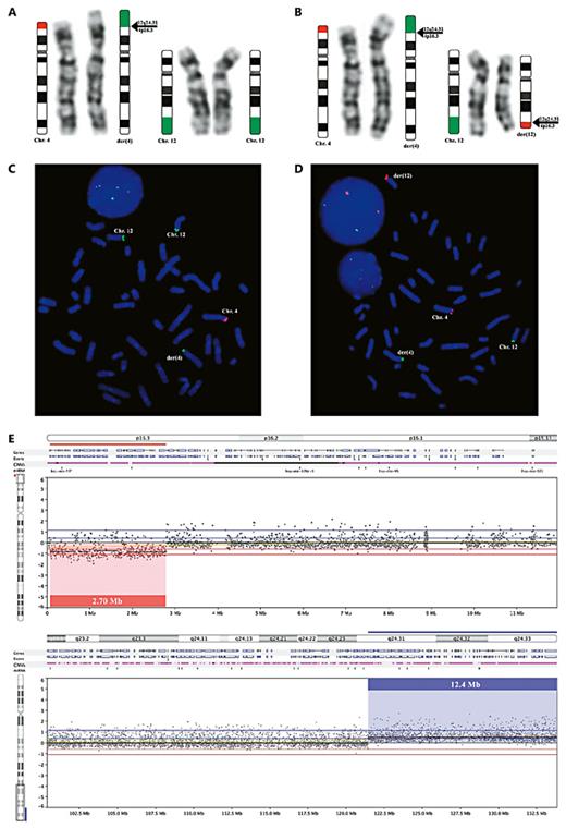 Partial Monosomy 4p and Trisomy 12q due to a t(4;12)(p16.3;q24.31 ...
