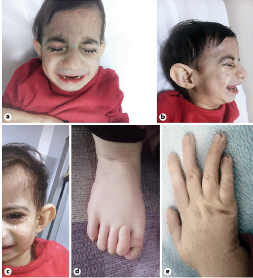 Novel Findings in Floating-Harbor Syndrome and a Mini-Review of the ...