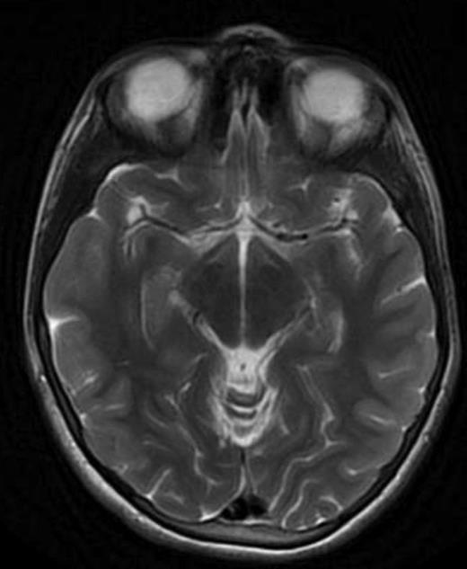 Many Faces of Diencephalic-Mesencephalic Junction Dysplasia Syndrome ...