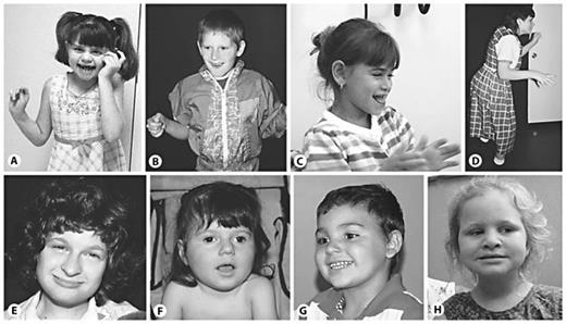 Molecular and Clinical Aspects of Angelman Syndrome | Molecular ...