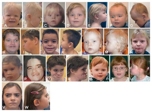 Update on Kleefstra Syndrome | Molecular Syndromology | Karger Publishers